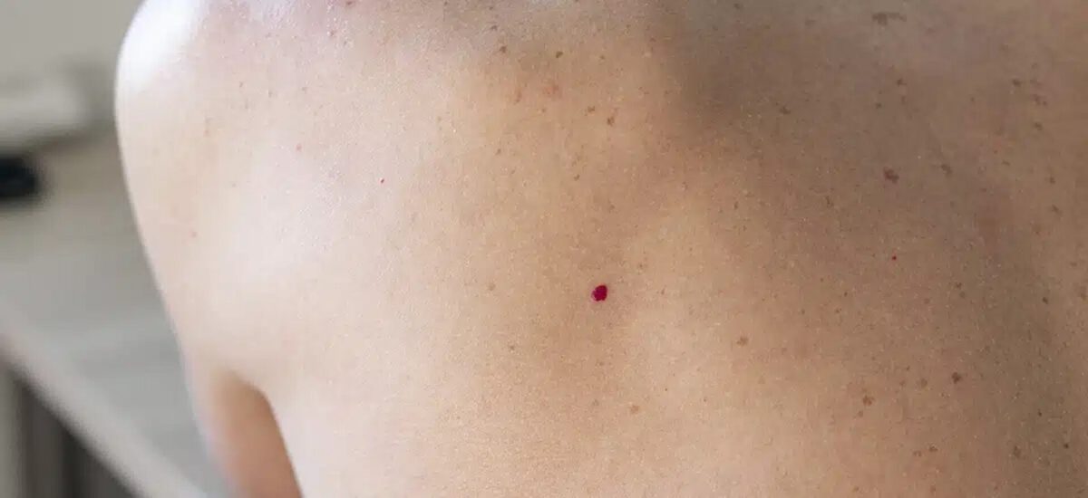 Lunares rojos en la piel: ¿qué son y por qué salen? - Artículo 14 ...